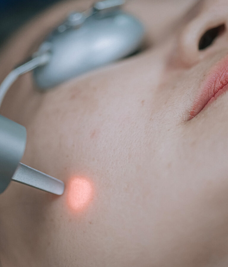 Fractional Laser ActiveFX In San Diego | La Jolla Cosmetic